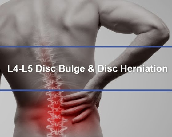 Understanding L4-L5 Disc Bulge/ Herniation - alleviatepainclinic