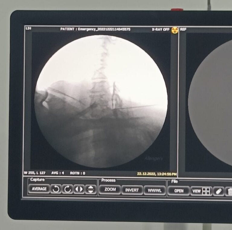 Cervical Epidural Injection: A Comprehensive Guide to Understanding and ...