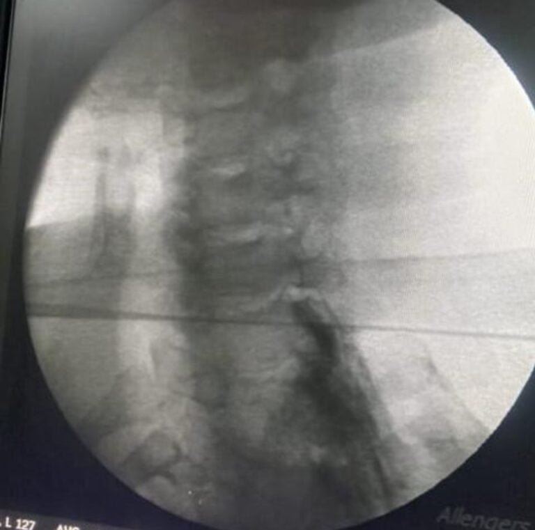 Cervical Epidural Injection: A Comprehensive Guide to Understanding and ...