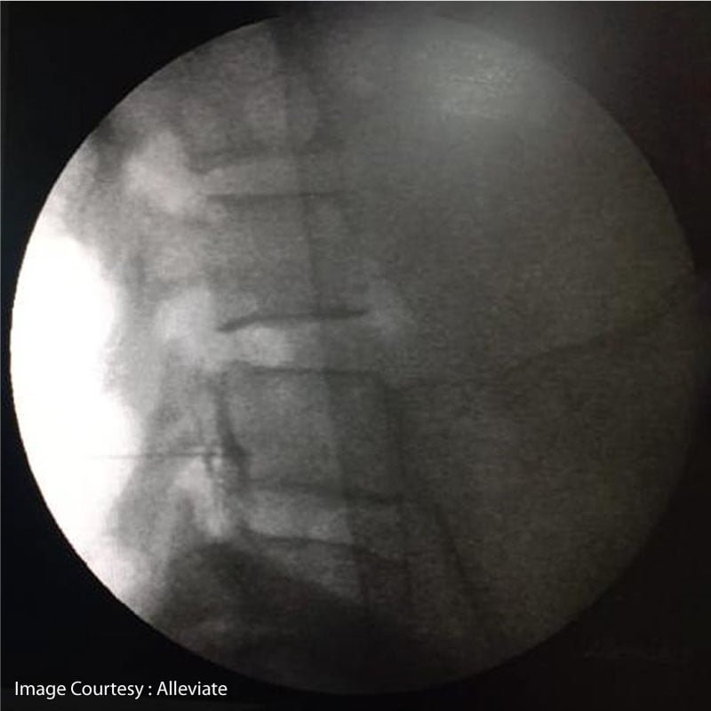 Back Pain Treatment | Pain Management | Transforaminal Epidural Injection