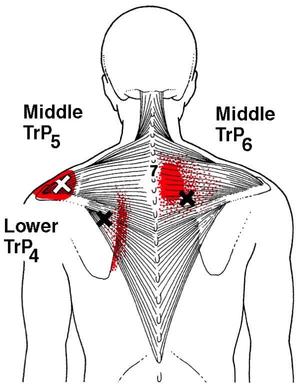 Trigger Points Causing Neck and Shoulder Pain: A Comprehensive Analysis