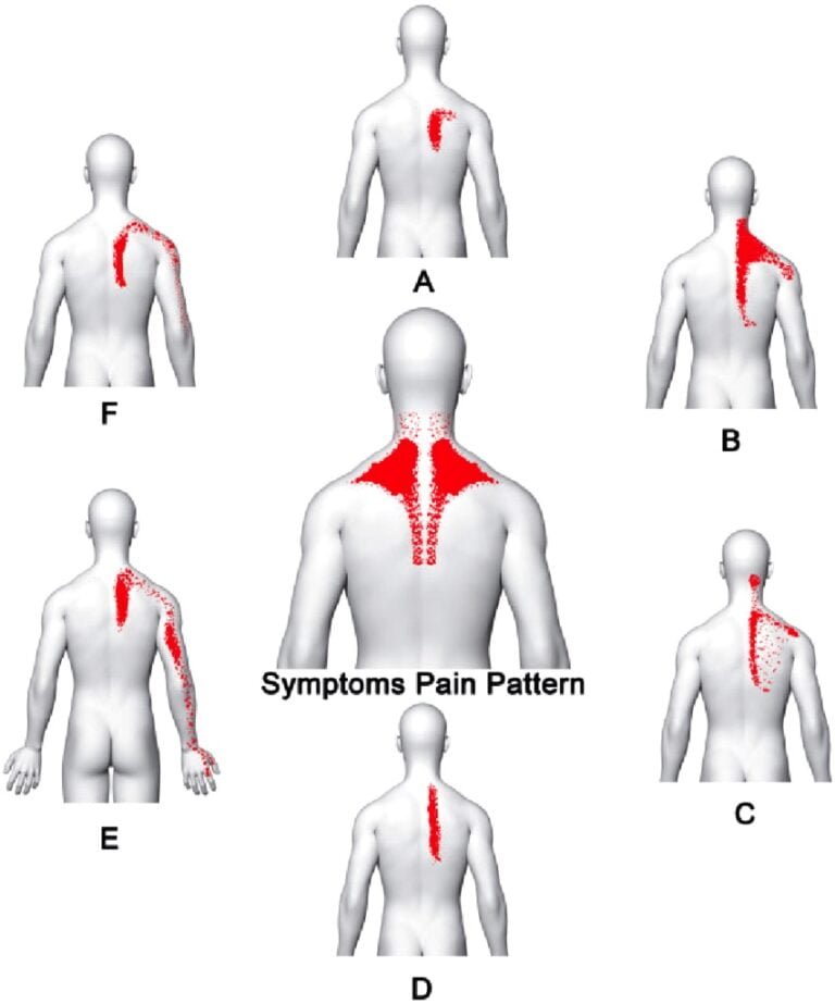 Trigger Points Causing Neck and Shoulder Pain: A Comprehensive Analysis