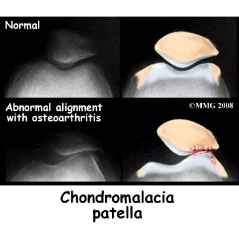 Chondromalacia Patella Treatment: Grades, Symptoms & Solutions