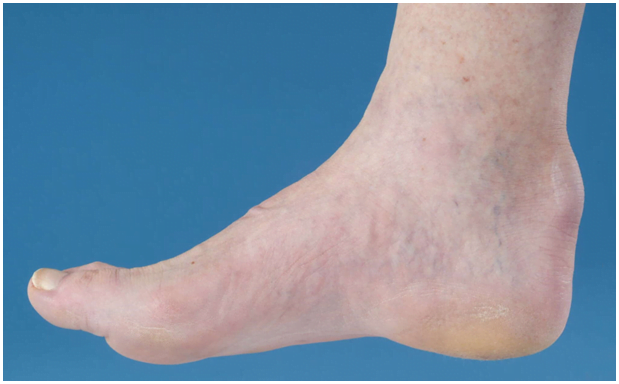 Achilles Tendonitis: PRP & Prolotherapy Treatments