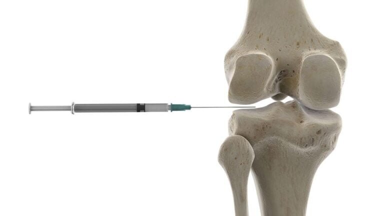 Top 10 Proven Nonsurgical Treatments for Knee Arthritis