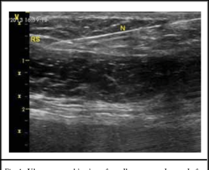 Trigger Point Injections: Unlocking Pain Relief with Ultrasound