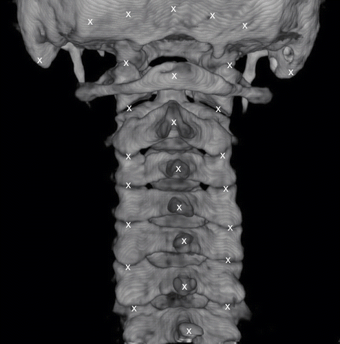 What is Craniocervical Instability(CCI)? | Effective Treatment Options
