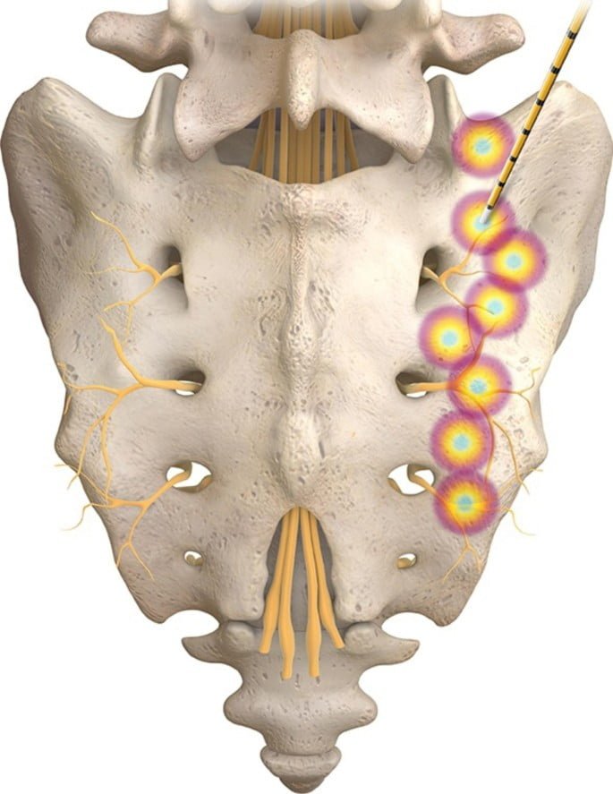 Non-Surgical Sacroiliac Joint Pain Relief | Alleviate Clinic