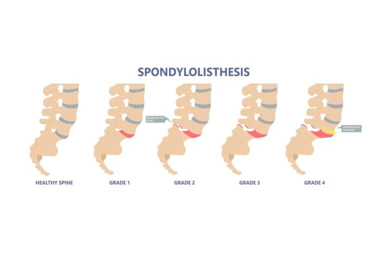 An Overview of Spondylolisthesis: Understanding the Condition and Treatment Approaches