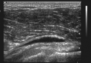 Subacromial Bursitis: Diagnosis, Pain Relief & Recovery