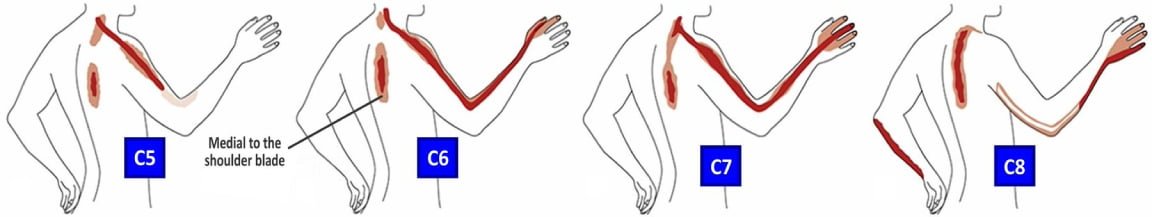 Cervical Radiculopathy Treatment in Bangalore - Alleviate Pain Clinic