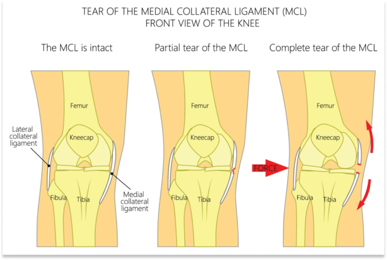 MCL & LCL Pain Relief and Treatment in Bangalore | Alleviate