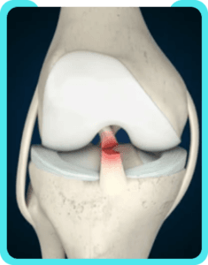 Twisted knee treatment ashwath nagar | ACL PCL Tear Sprain