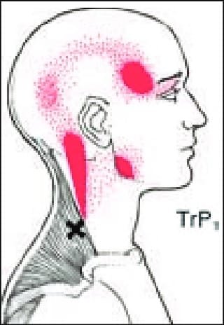 Neck and Shoulder Pain Trigger Points: Comprehensive Guide