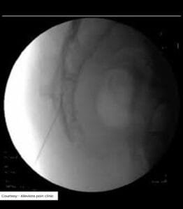 Caudal Epidural Injection: Pain Relief Guide - Alleviate Pain Clinic