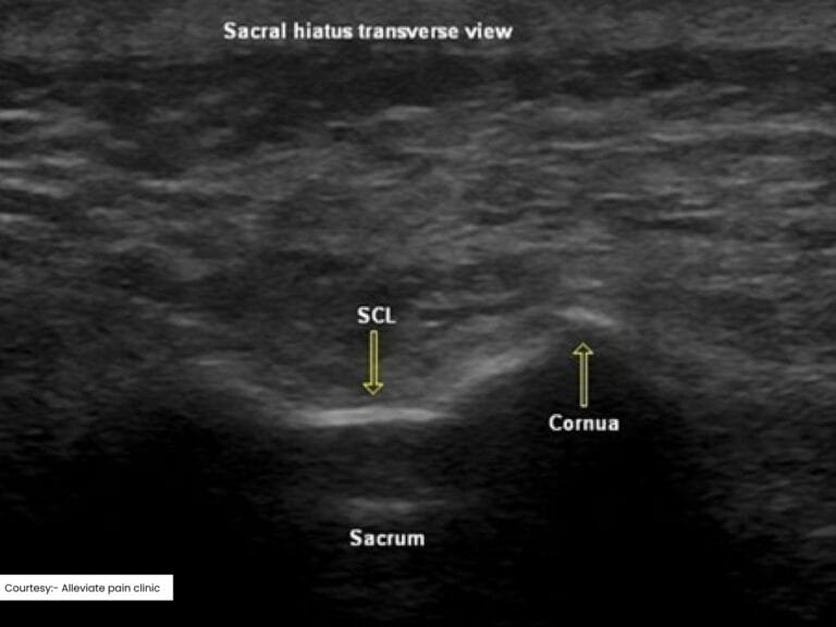 Caudal Epidural Injection: Pain Relief Guide - Alleviate Pain Clinic