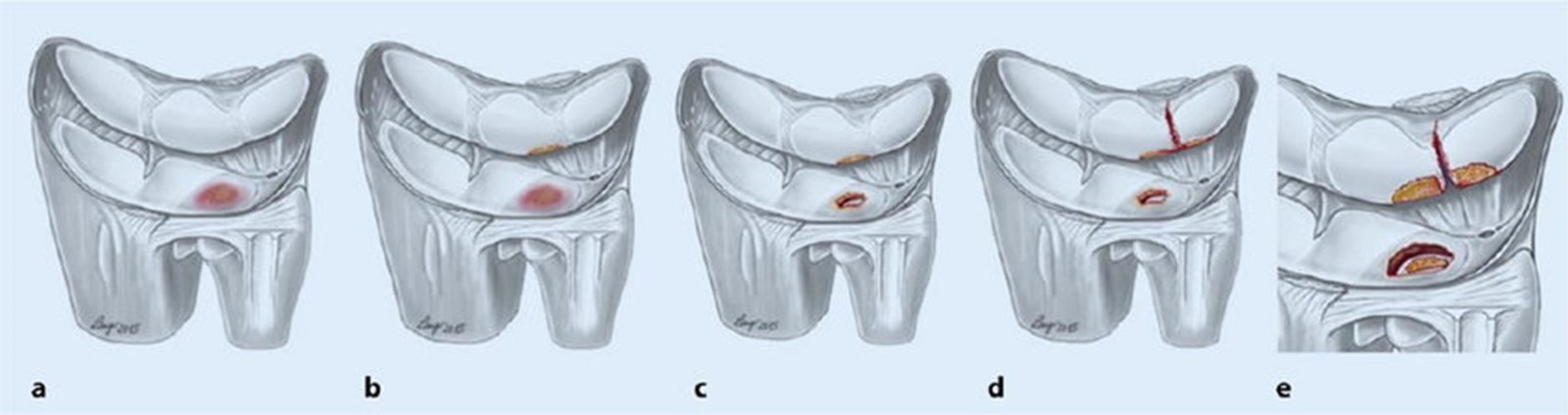 TFCC Wrist Injury: Causes, Symptoms, Diagnosis & Treatment