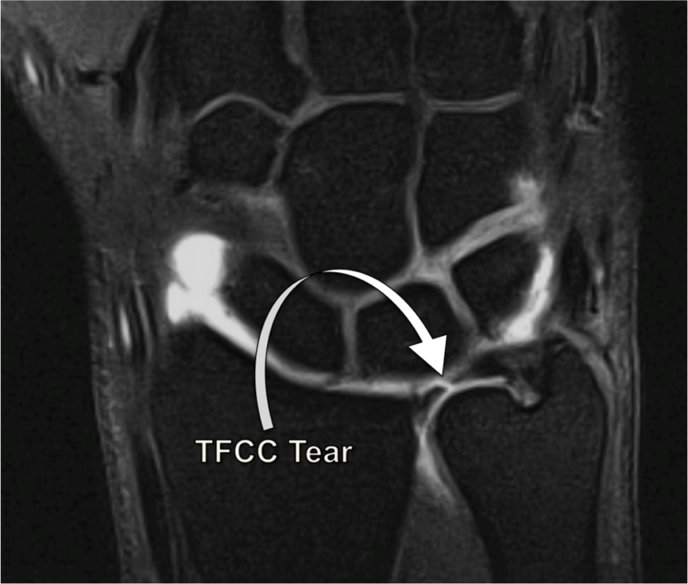 TFCC Wrist Injury: Causes, Symptoms, Diagnosis & Treatment