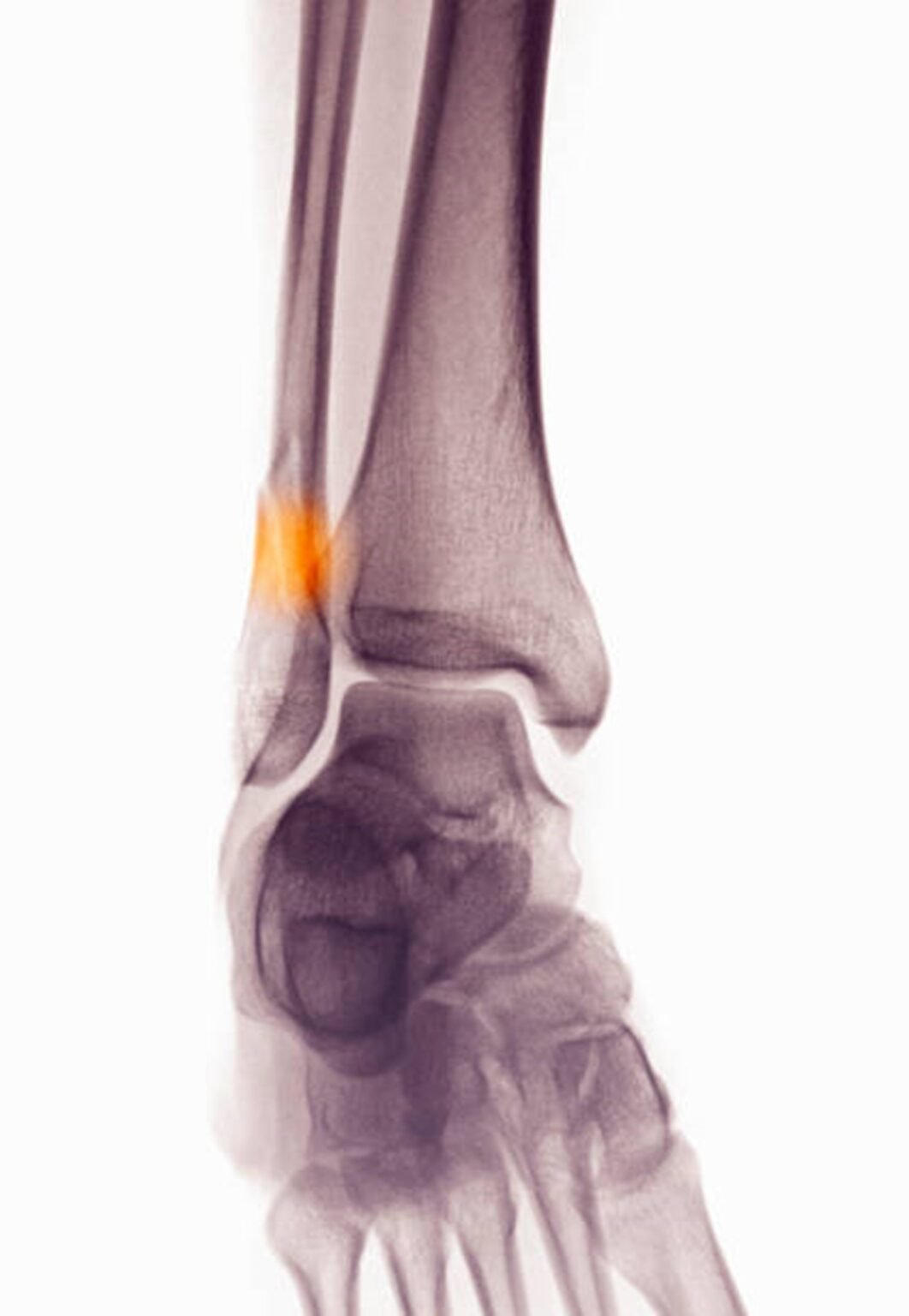 Ankle Pain While Walking? Causes, Symptoms, Diagnosis & Treatment